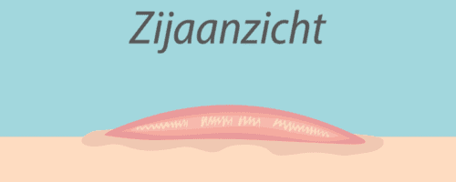 Littekens verzorgen en verminderen - SCARBAN