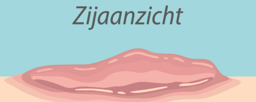 Littekens verzorgen en verminderen - SCARBAN